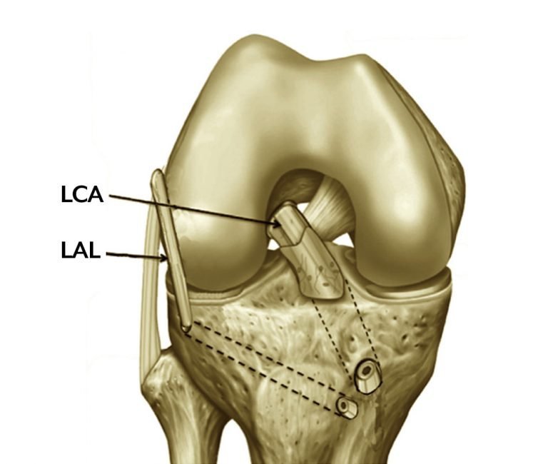 LCA - Ligamento Cruzado Anterior em São Paulo | Dr. Guilherme Losso